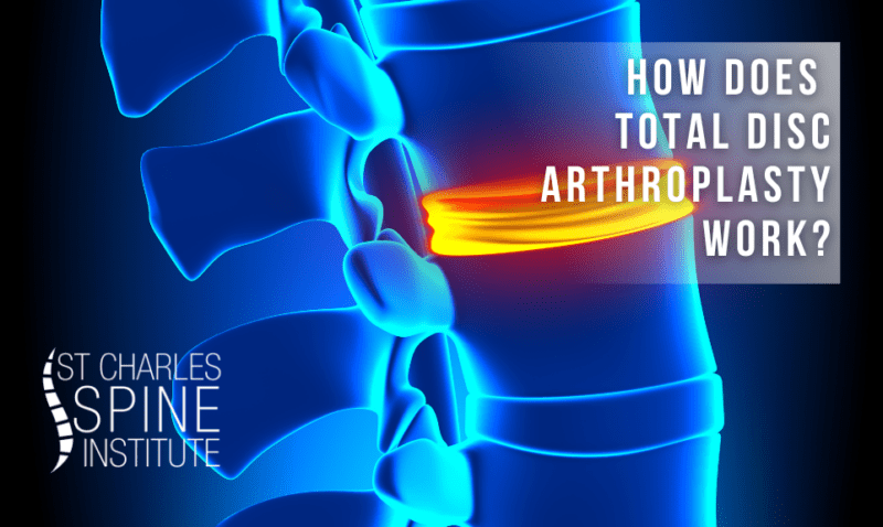 How Does Total Disc Arthroplasty Work? - St. Charles Spine Institue