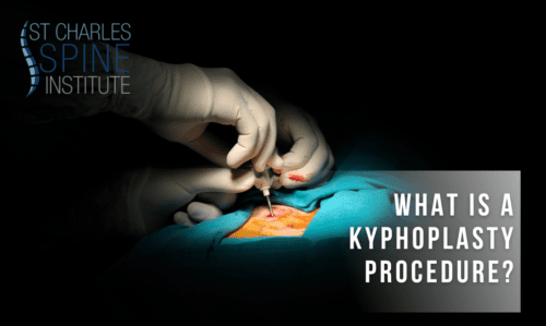 What Is a Kyphoplasty Procedure? - St. Charles Spine Institue