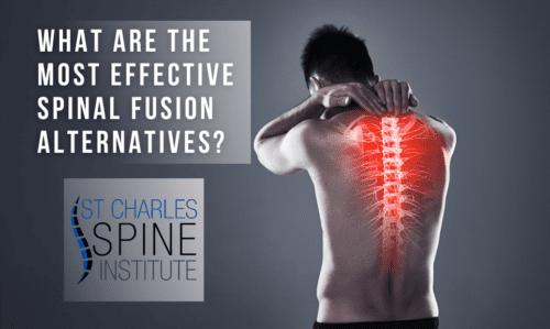 What Are the Most Effective Spinal Fusion Alternatives? - St. Charles ...