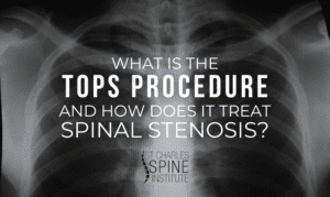 What Is the TOPS Procedure and How Does It Treat Spinal Stenosis - St ...