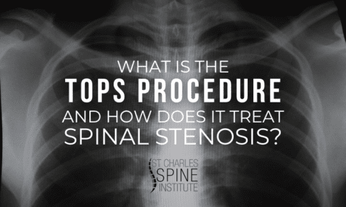 What Is the TOPS Procedure and How Does It Treat Spinal Stenosis - St ...