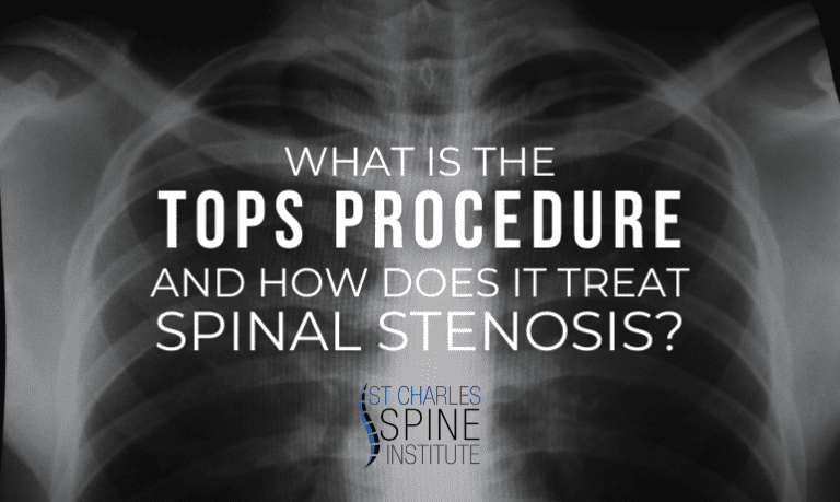 What Is the TOPS Procedure and How Does It Treat Spinal Stenosis - St ...